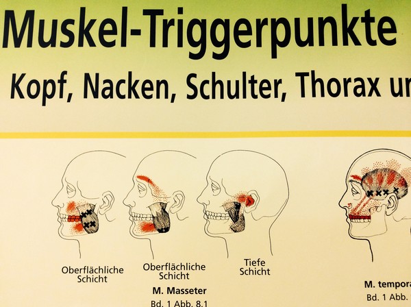 Triggerpunkttherapie